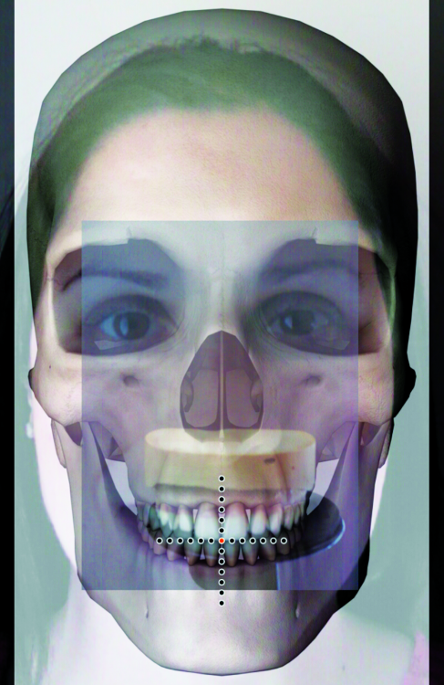 Dental News - The Virtual Facebow: A digital companion to implantology