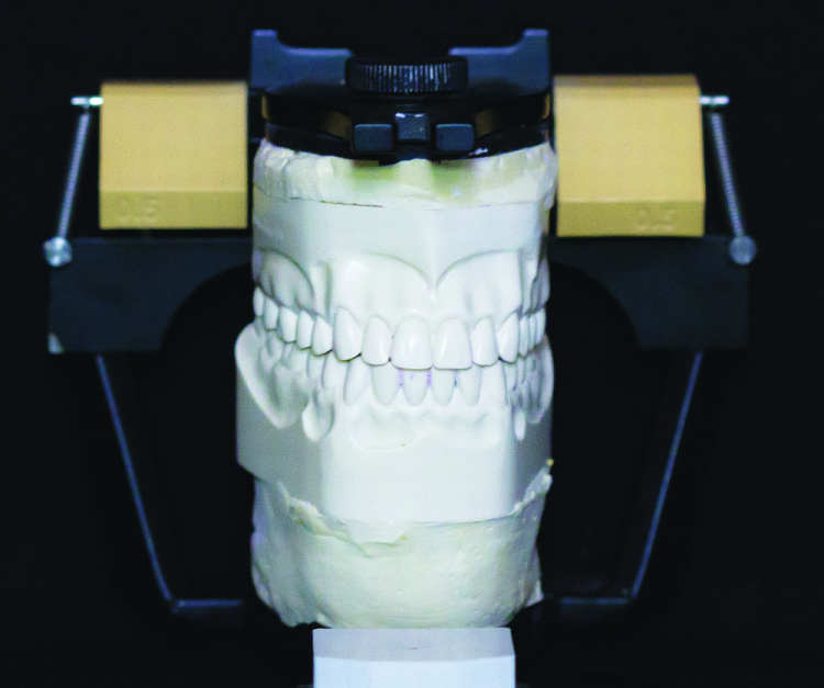 Dental News - The Virtual Facebow: A digital companion to implantology
