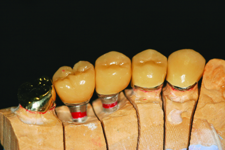 Dental News - The Virtual Facebow: A digital companion to implantology