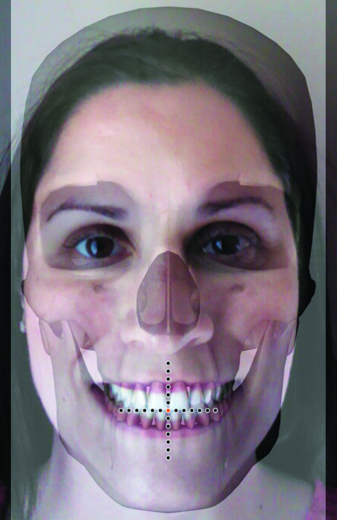 Dental News - The Virtual Facebow: A digital companion to implantology