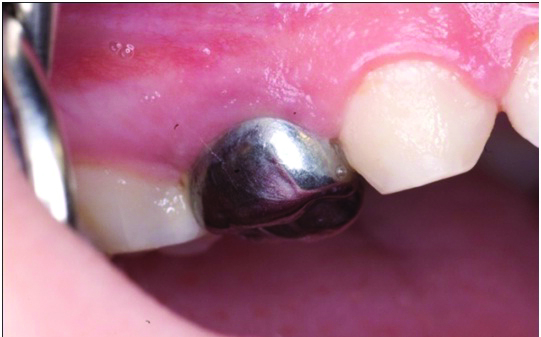 DT News - MEA - The Hall Technique: The novel method in restoring the ...