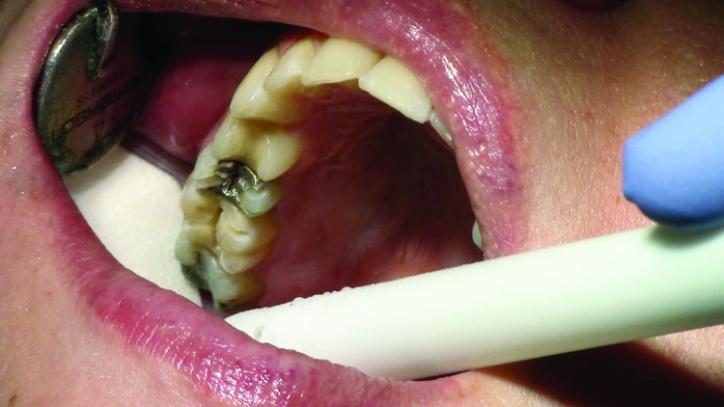 Dental News - A minimally invasive approach according to biomechanical ...