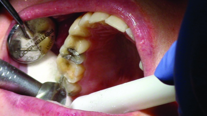 Dental News - A minimally invasive approach according to biomechanical ...
