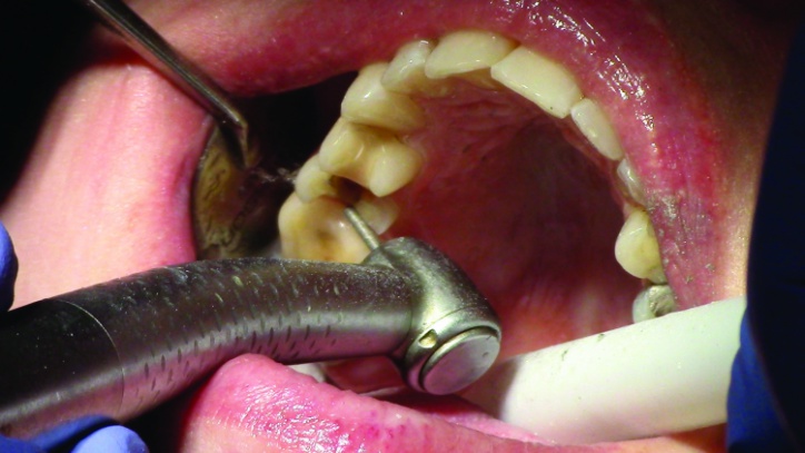 Dental News - A minimally invasive approach according to biomechanical ...