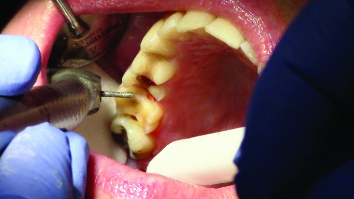 Dental News - A minimally invasive approach according to biomechanical ...