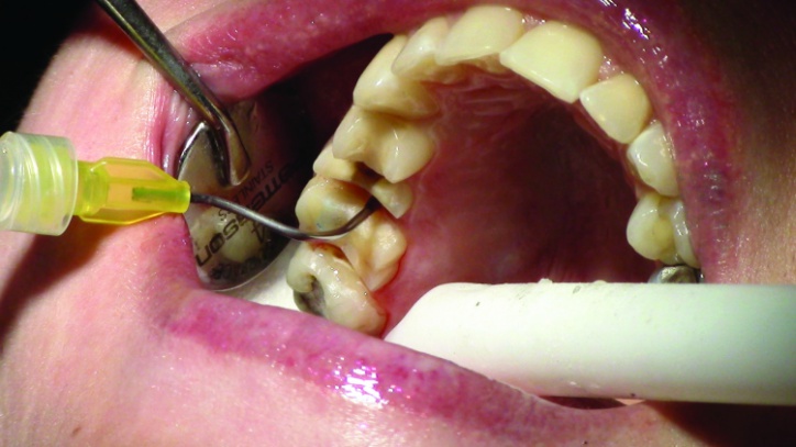 Dental News - A minimally invasive approach according to biomechanical ...