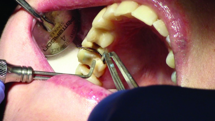 Dental News - A minimally invasive approach according to biomechanical ...