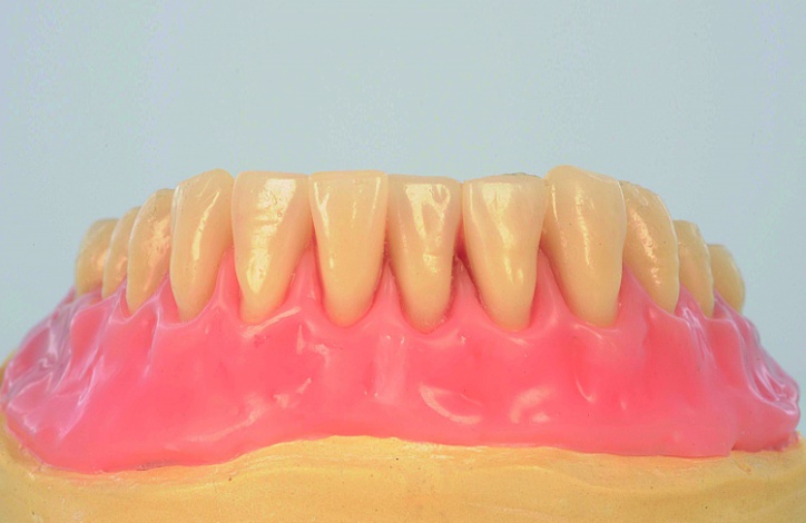 Dental News - Evaluating the fit of removable dentures with ...