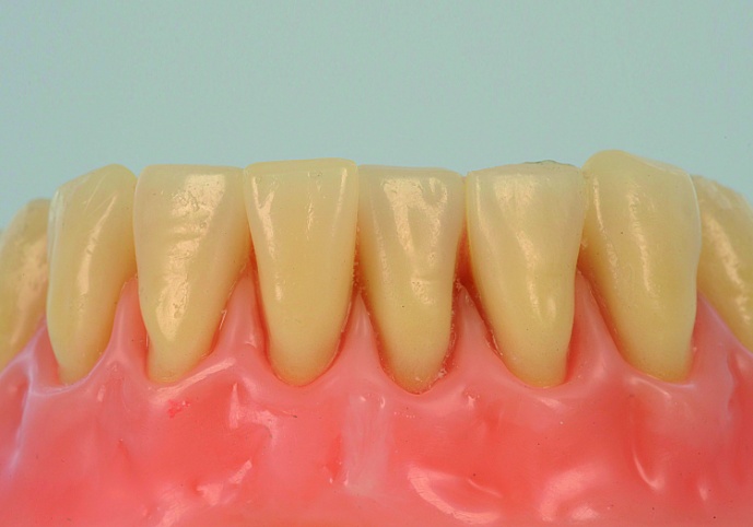 Dental News - Evaluating the fit of removable dentures with ...
