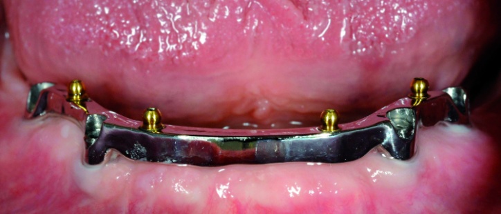 Dental News - Evaluating the fit of removable dentures with ...