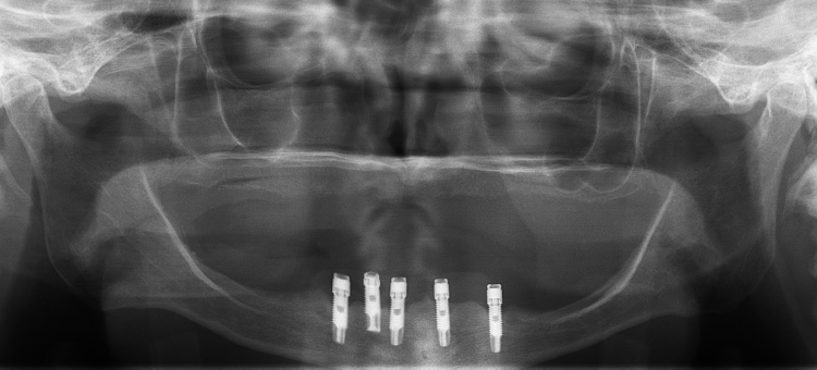 Dental News - Treatment options for the edentulous arch