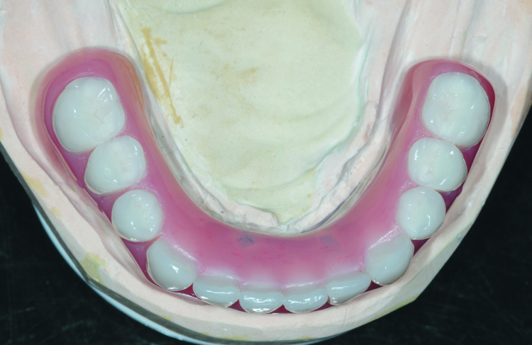 Dental News - Treatment options for the edentulous arch