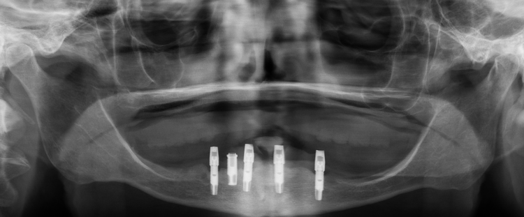 Dental News - Treatment options for the edentulous arch