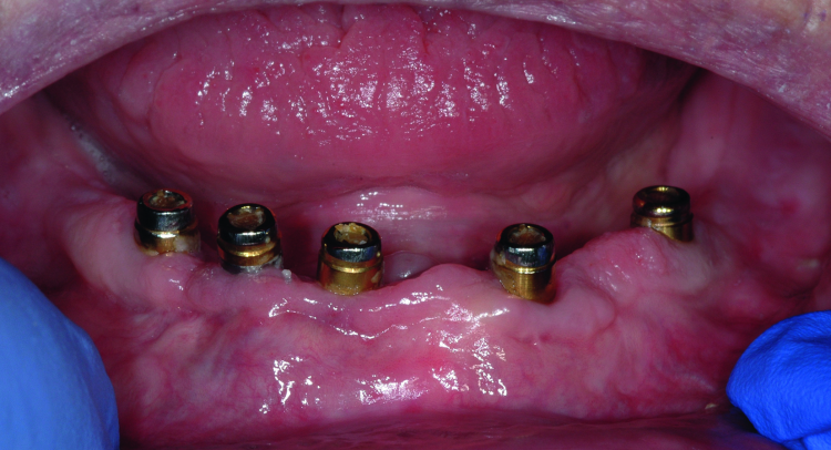 Dental News - Treatment options for the edentulous arch