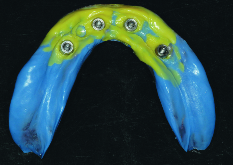 Dental News - Treatment options for the edentulous arch