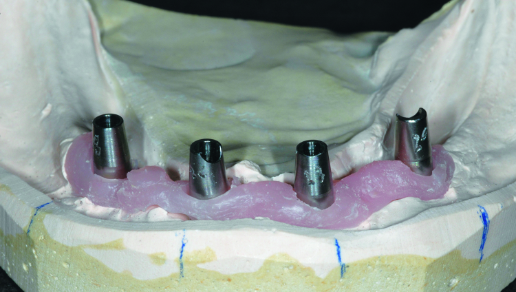 Dental News - Treatment options for the edentulous arch