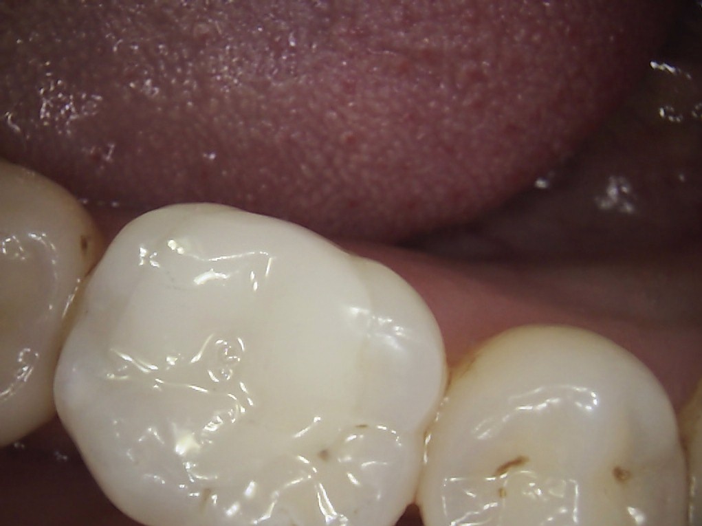 DT News - MEA - Removal of leaking amalgam restorations and placement ...