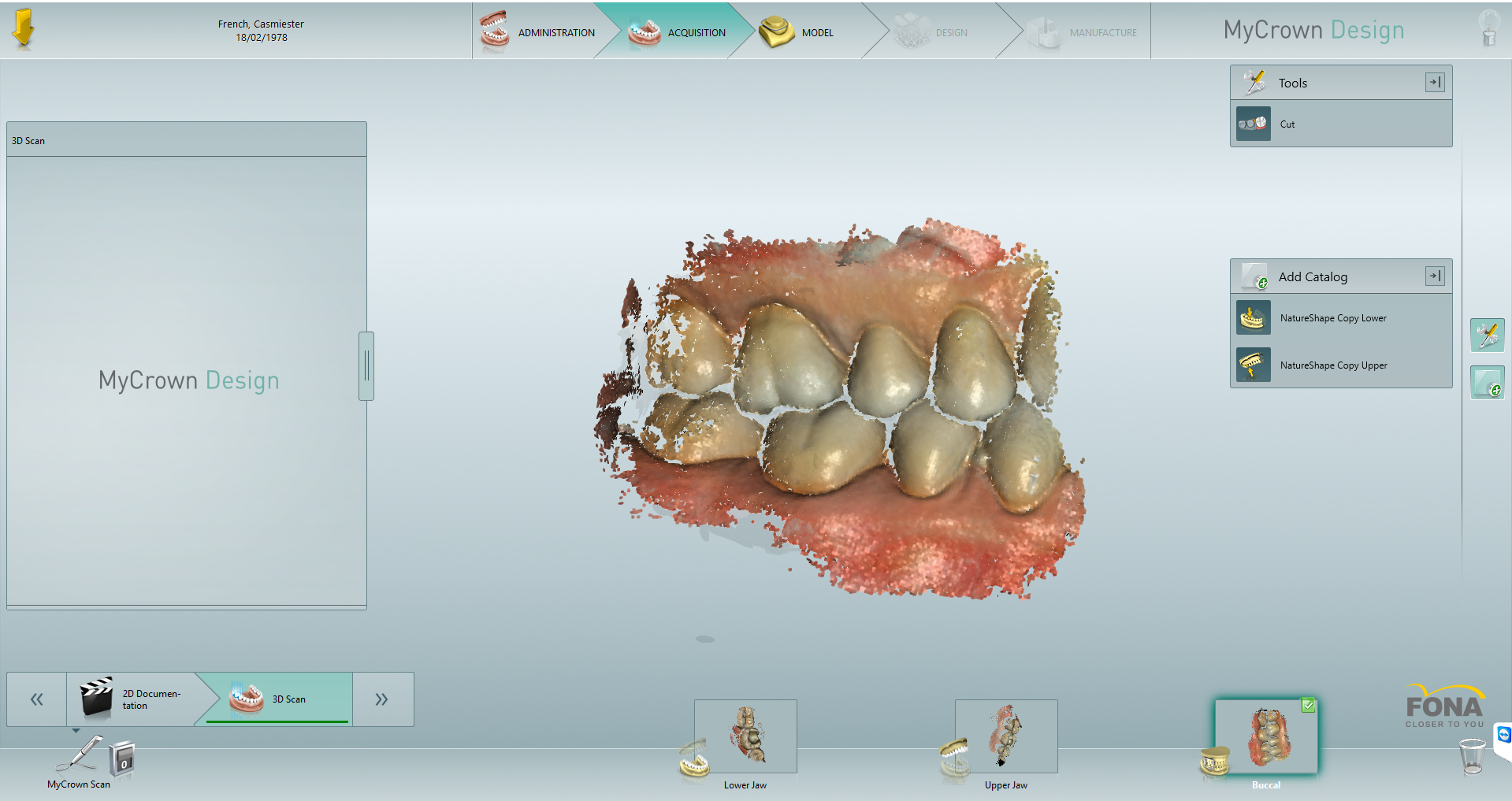 DT News - MEA - Removal of leaking amalgam restorations and placement ...