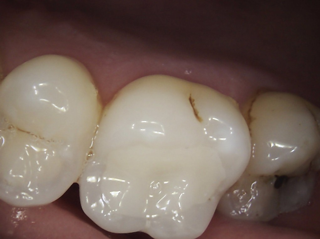 DT News - MEA - Removal of leaking amalgam restorations and placement ...