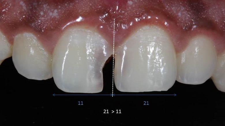 DT News - India - Direct composite restorations in maxillary central ...