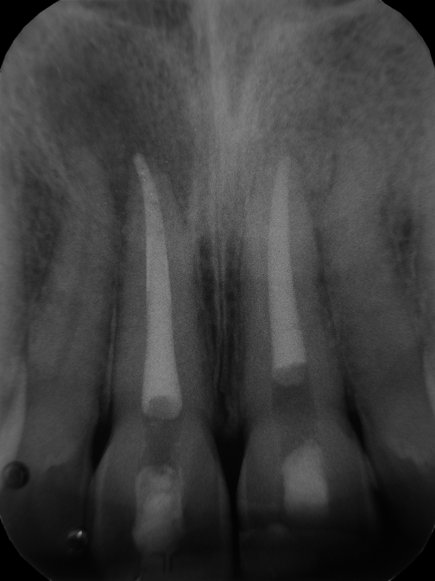 Dental News - Irrigating the root canal: A case report