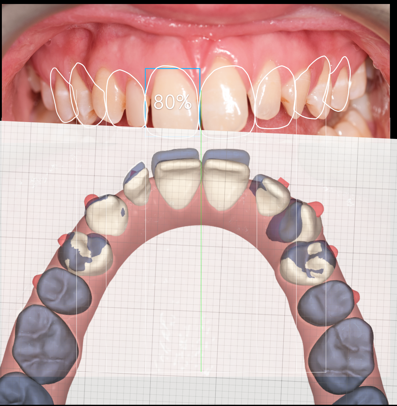 DT News - MEA - A combined digital orthodontic and restorative approach