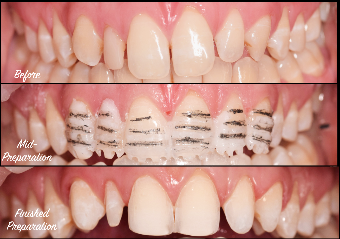 DT News - MEA - A combined digital orthodontic and restorative approach