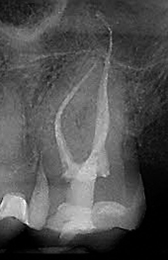 DT News - France - Préparer les cavités d’accès endodontique – Pour des ...
