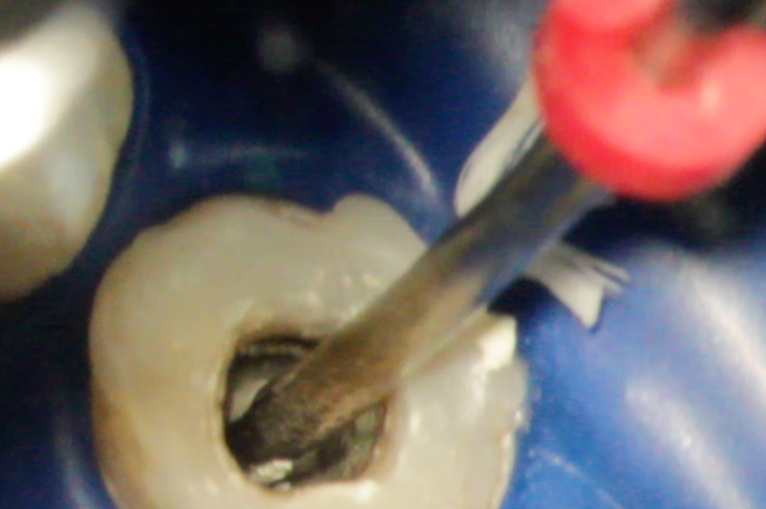 Dental News - MTA placement with the Produits Dentaires MAP System