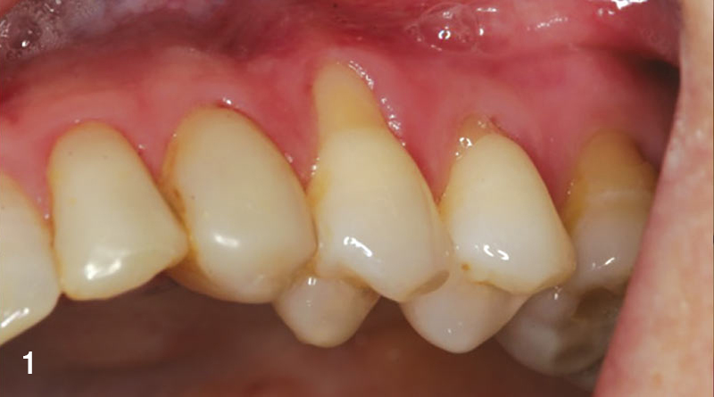 Patient with severe gum recession treated with Oracell.