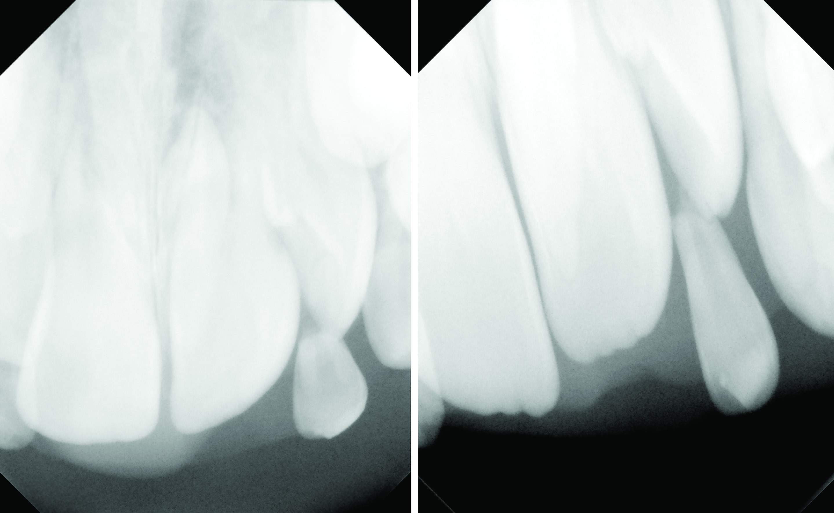 DT News - MEA - An Unerupted Maxillary Permanent Central Incisor and ...
