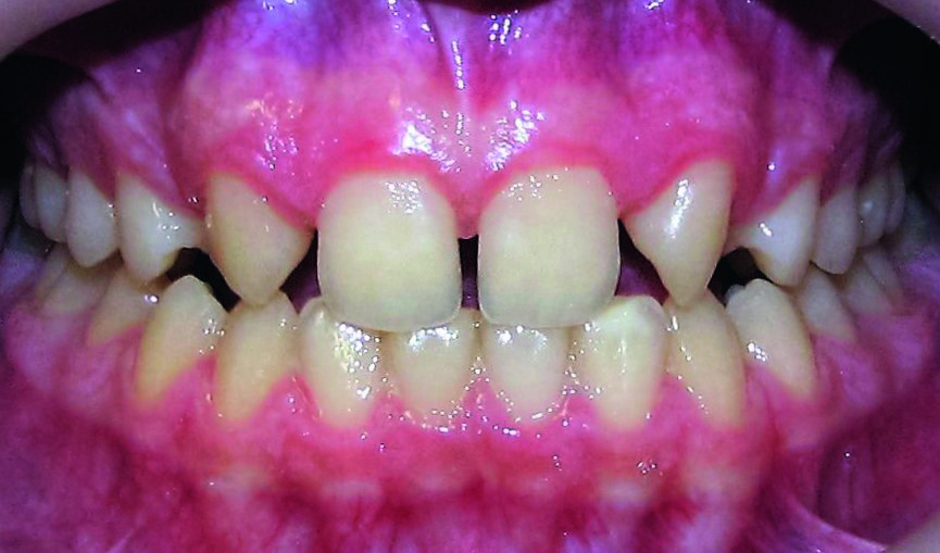 Dental News - Orthodontic management of maxillary lateral incisors agenesis