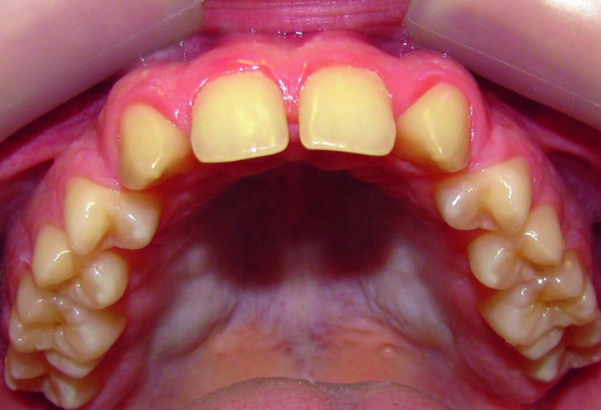 Dental News - Orthodontic management of maxillary lateral incisors agenesis