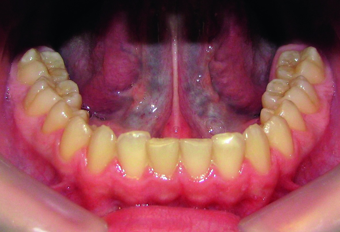 Dental News - Orthodontic management of maxillary lateral incisors agenesis