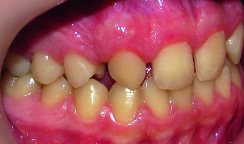 Dental News - Orthodontic management of maxillary lateral incisors agenesis