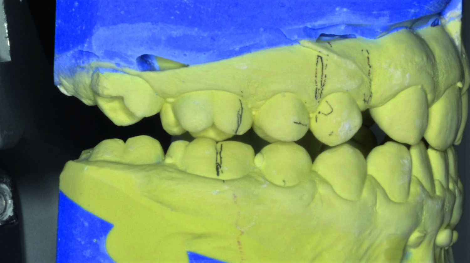 Dental News - Orthodontic management of maxillary lateral incisors agenesis