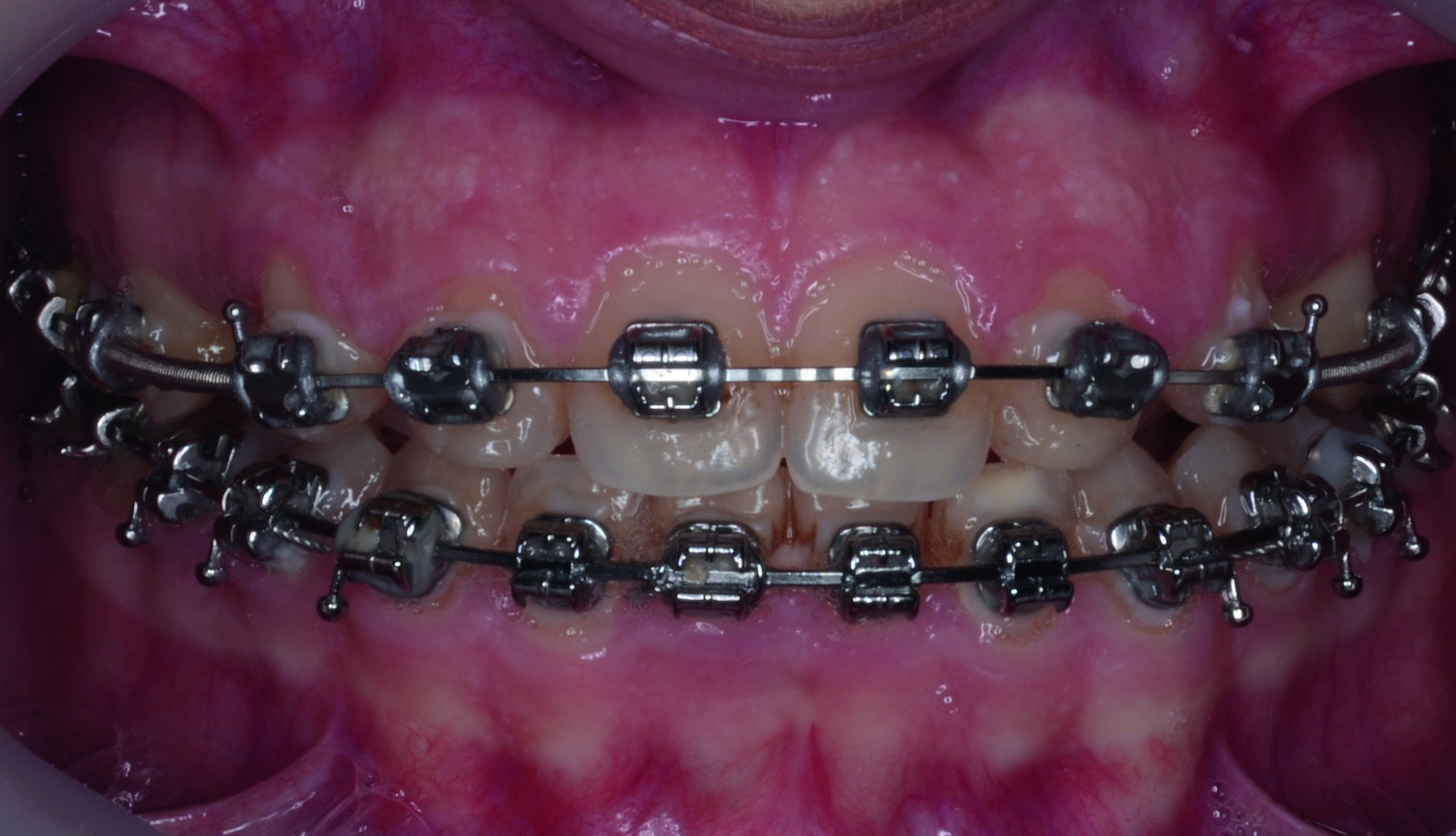 Dental News - Orthodontic management of maxillary lateral incisors agenesis
