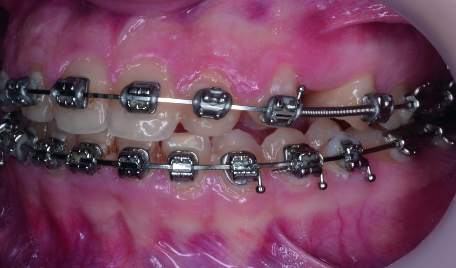 Dental News - Orthodontic management of maxillary lateral incisors agenesis
