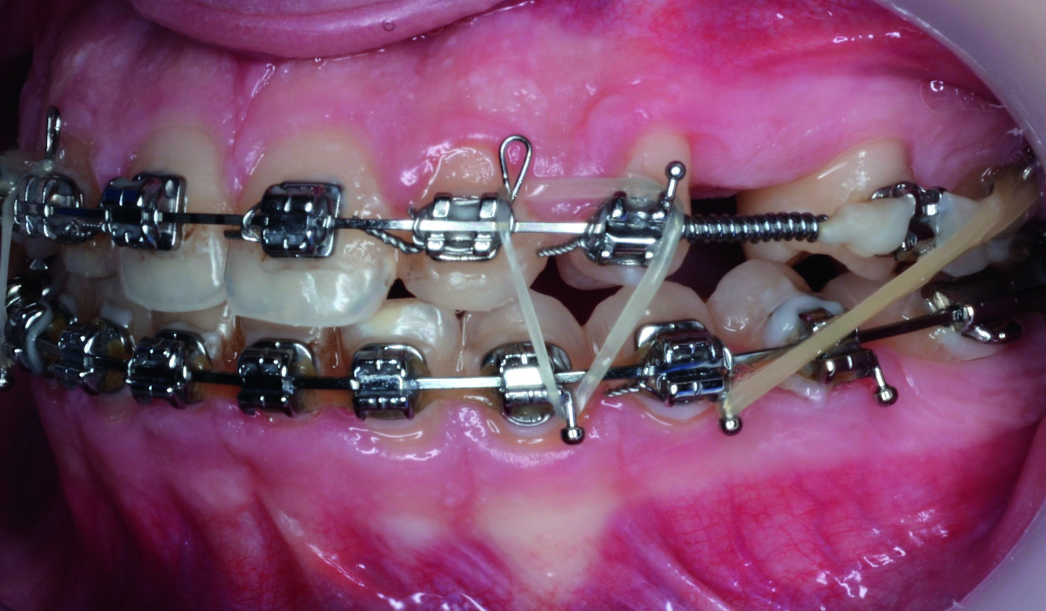 Dental News - Orthodontic management of maxillary lateral incisors agenesis