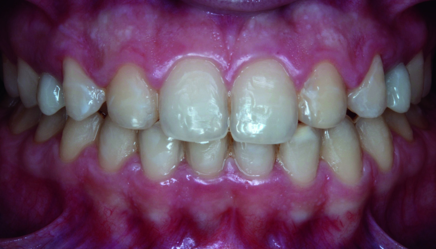 Dental News - Orthodontic management of maxillary lateral incisors agenesis