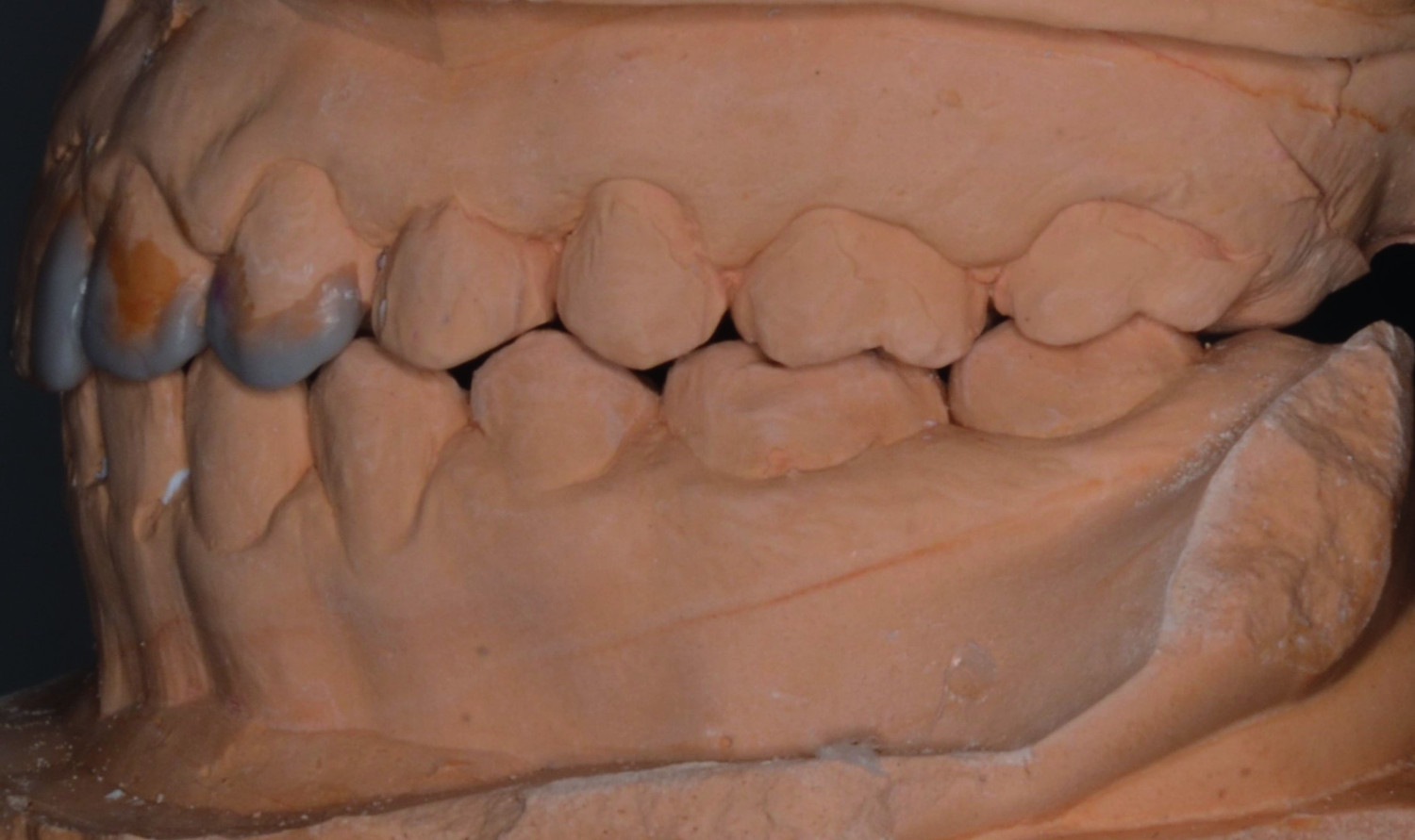 Dental News - Orthodontic management of maxillary lateral incisors agenesis