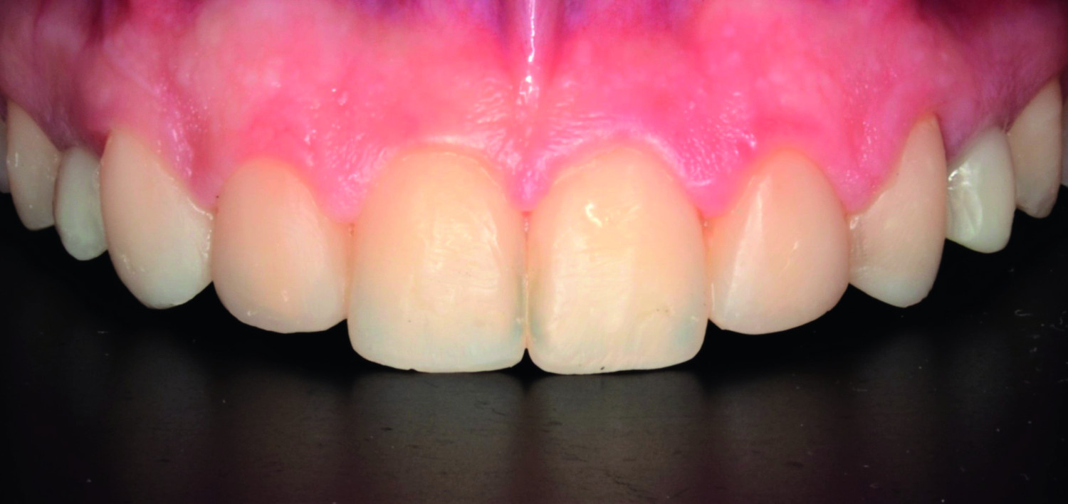Dental News - Orthodontic management of maxillary lateral incisors agenesis