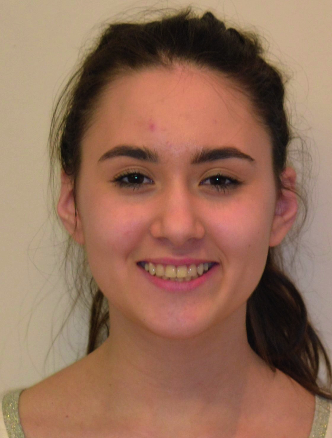 Dental News - Orthodontic management of maxillary lateral incisors agenesis