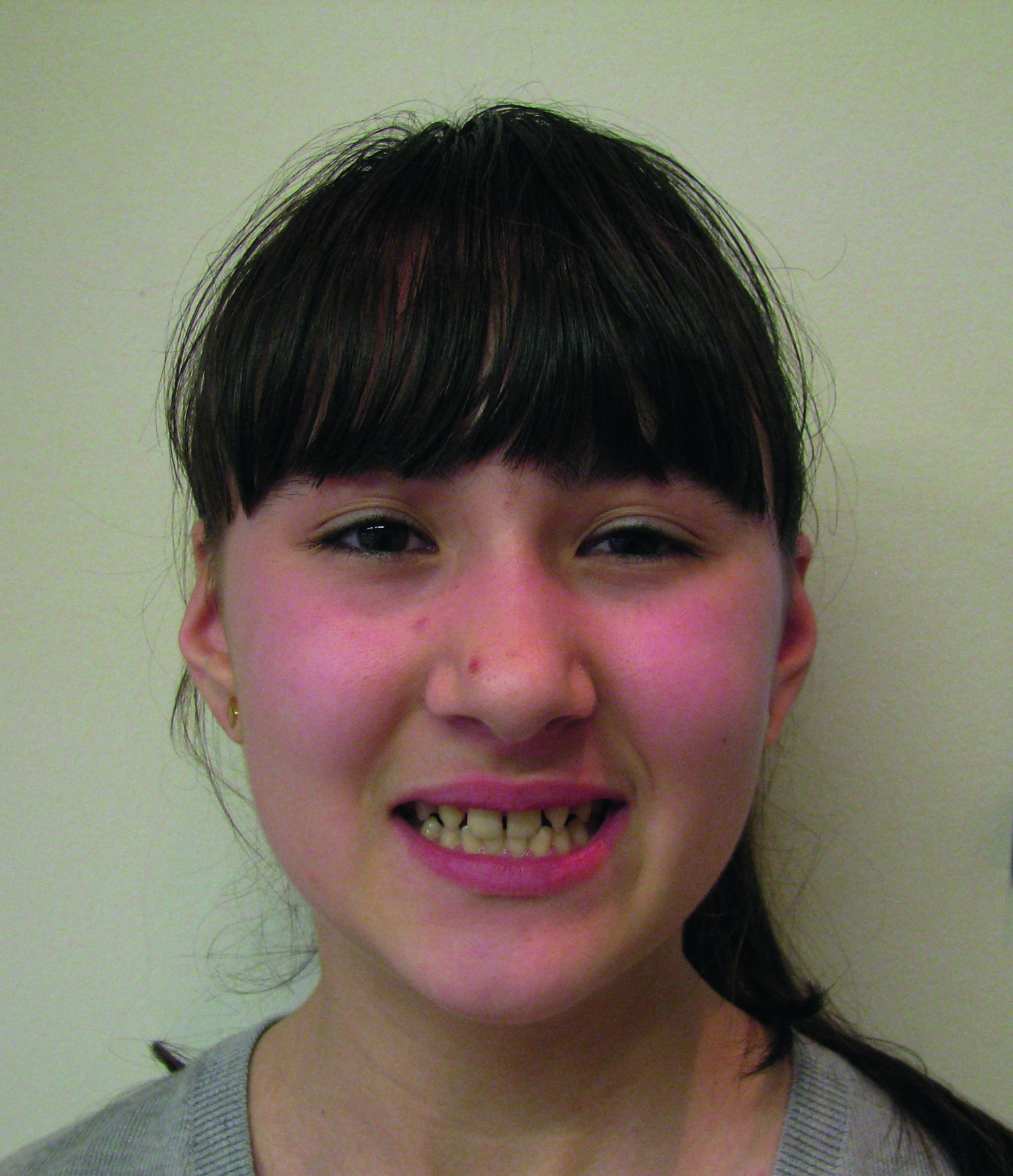 Dental News - Orthodontic management of maxillary lateral incisors agenesis