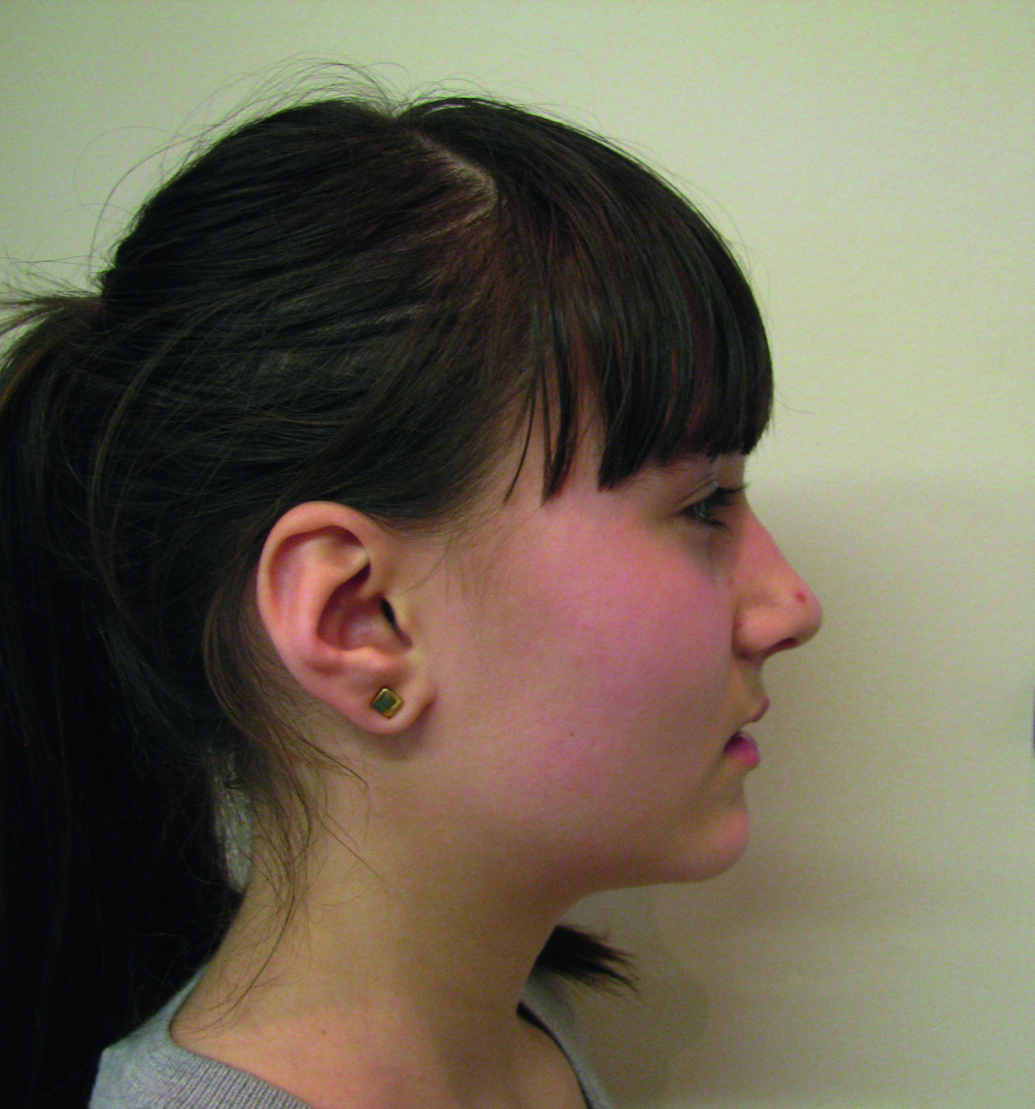 Dental News - Orthodontic management of maxillary lateral incisors agenesis