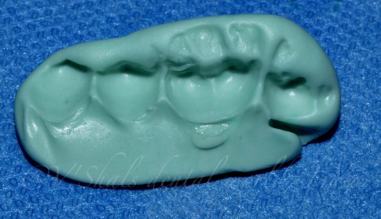 DT News - India - Custom shield Technique