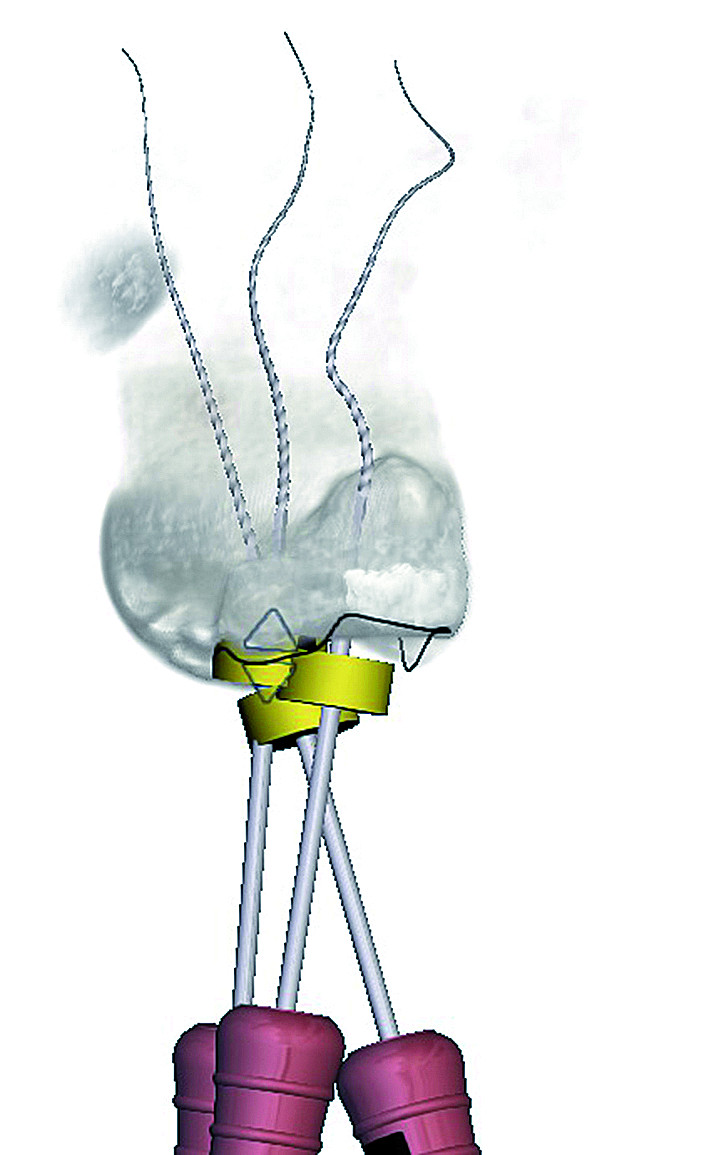 Dental News - 3D Endo Software, glide path management and WaveOne Gold