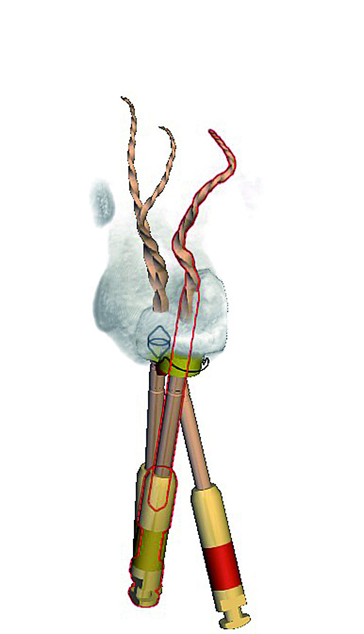 Dental News - 3D Endo Software, glide path management and WaveOne Gold