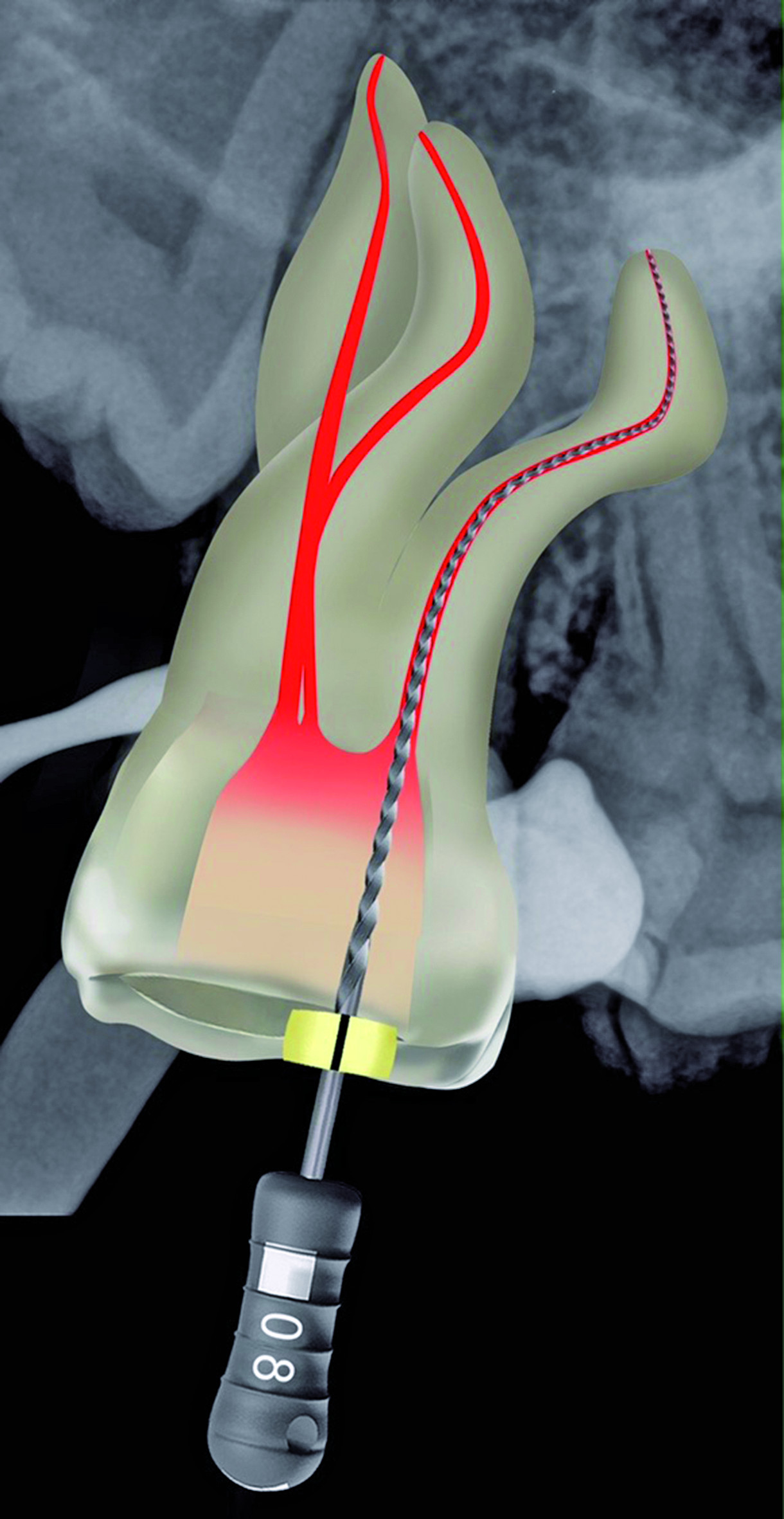 Dental News - 3D Endo Software, glide path management and WaveOne Gold
