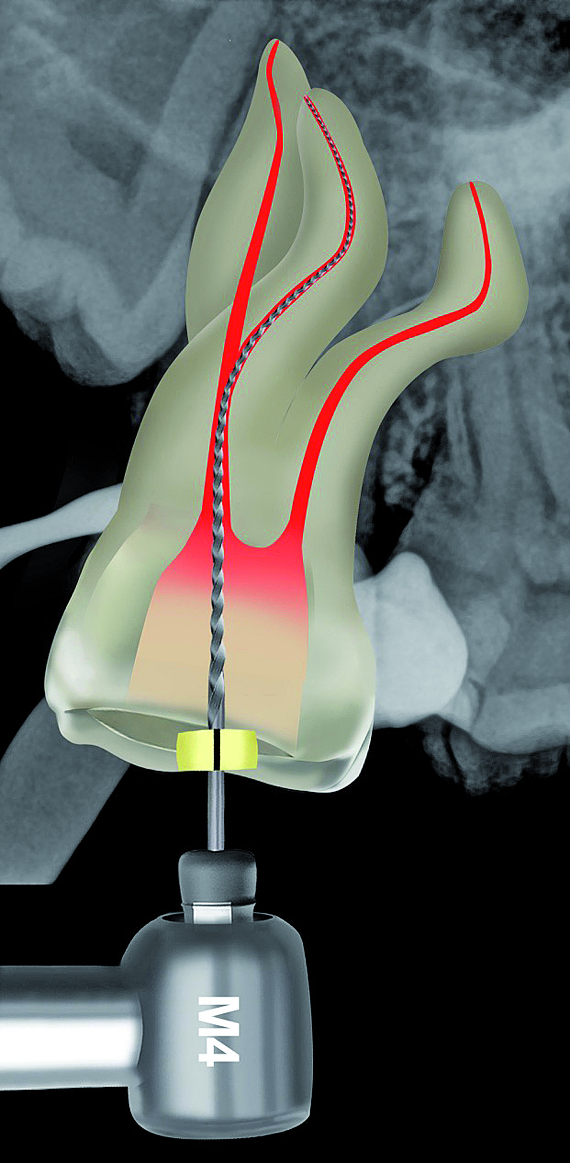 Dental News - 3D Endo Software, glide path management and WaveOne Gold